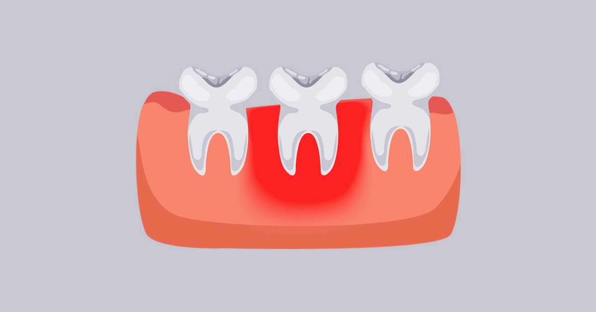 How to Stop Gum Bleeding Around One Tooth: Effective Remedies